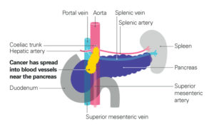 Stage 3 pancreatic cancer - Pancreatic Cancer UK