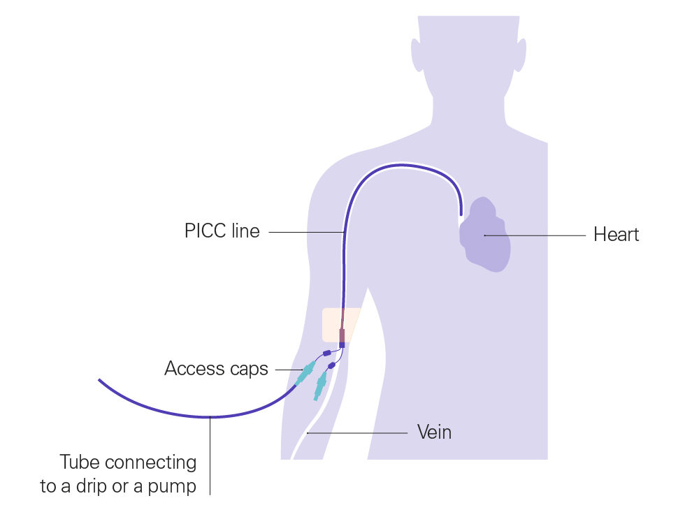 How is chemotherapy given? - Pancreatic Cancer UK