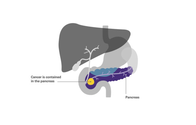 What do my test results mean? - Pancreatic Cancer UK