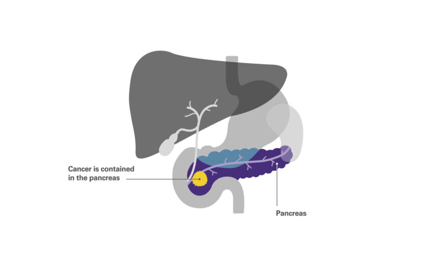 What do my test results mean? - Pancreatic Cancer UK