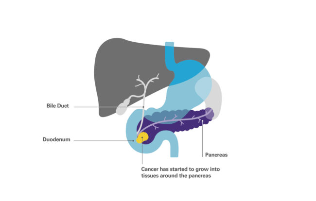 What do my test results mean? - Pancreatic Cancer UK