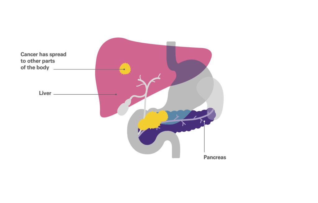What do my test results mean? - Pancreatic Cancer UK