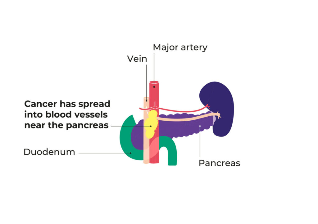 What is stage 3 pancreatic cancer? - Pancreatic Cancer UK