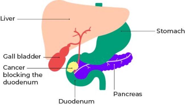 Feeling and being sick at the end of life - Pancreatic Cancer UK