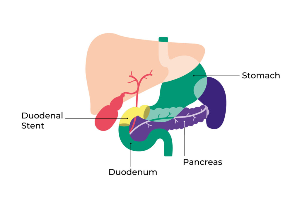 Stents for a blocked duodenum - Pancreatic Cancer UK